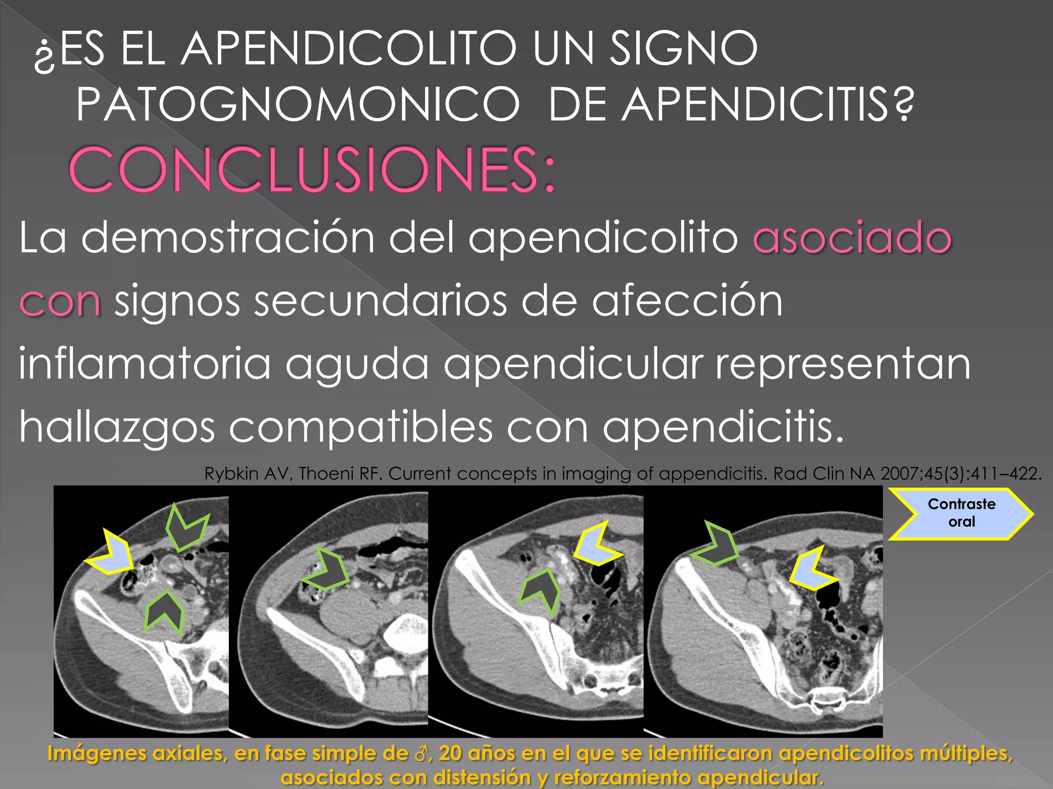 Es el apendicolito un signo patognomonico de apendicitis | PDF