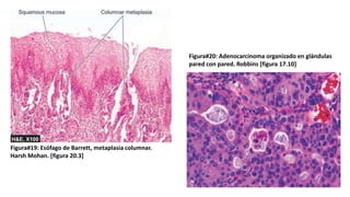 Cáncer de Esófago | PPTX