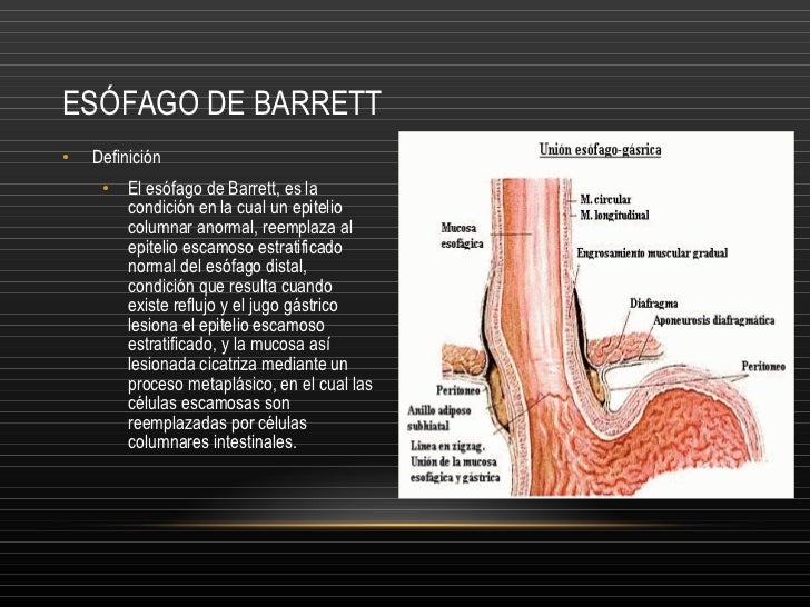 ESOFAGO DE BARRET