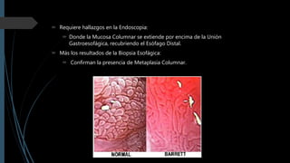 Esófago de barrett | PPTX