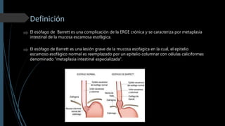 Esófago de barrett | PPTX