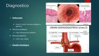 Esófago de barrett | PPTX