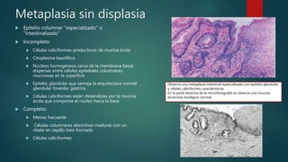 Esófago de barrett | PPTX