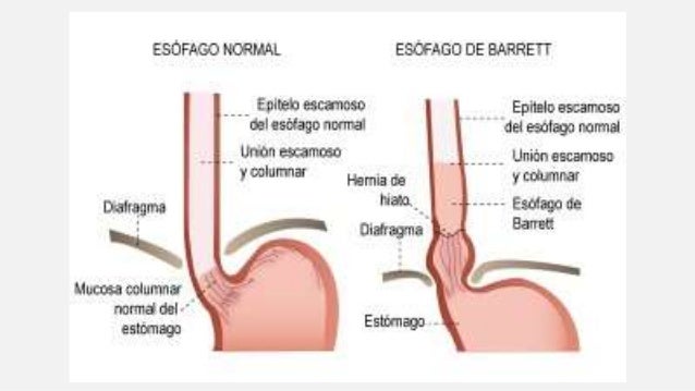Esófago de barrett y diverticulos del esófago