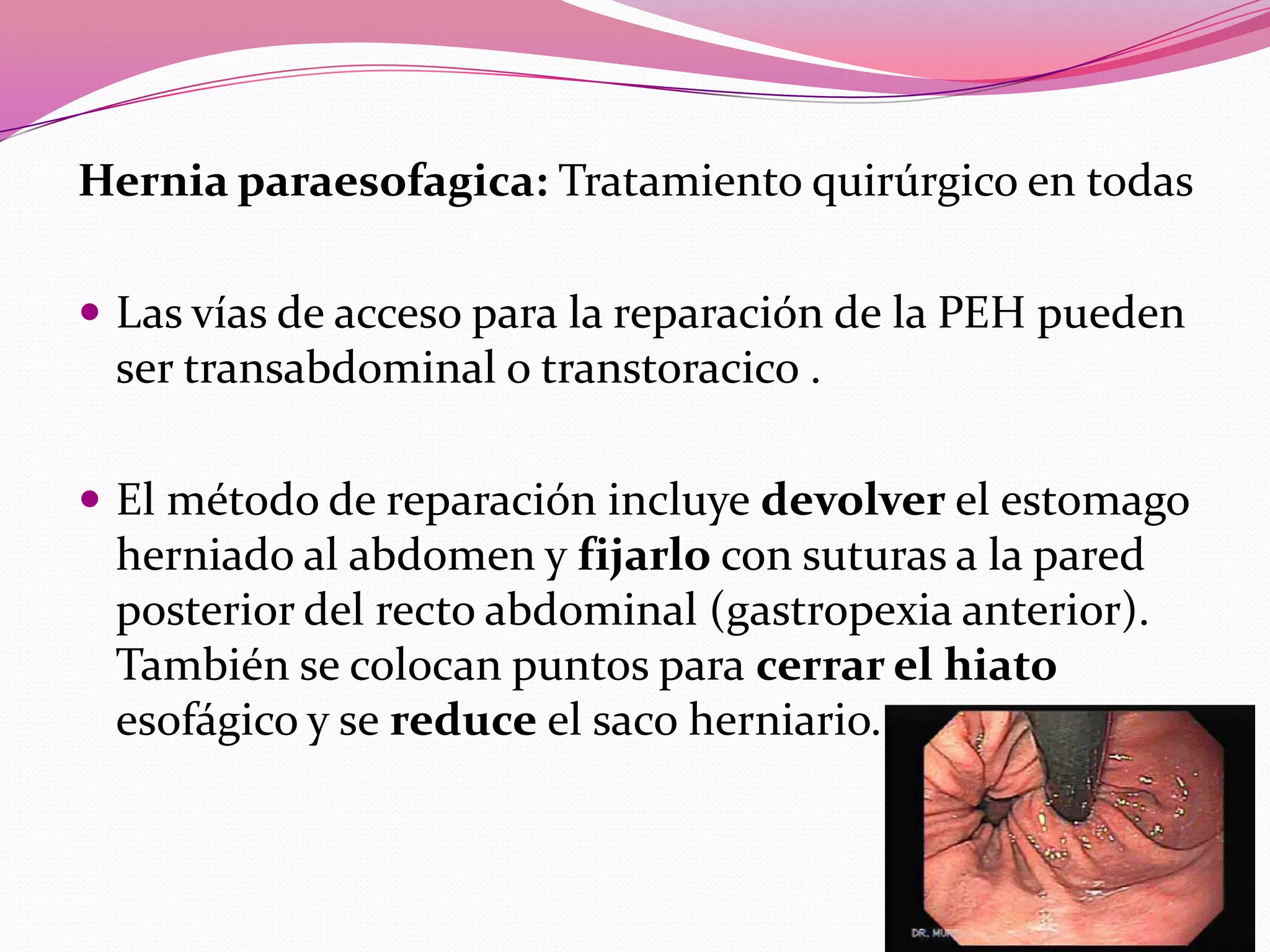 Esófago, hernia hiatal, y acalasia | PPTX
