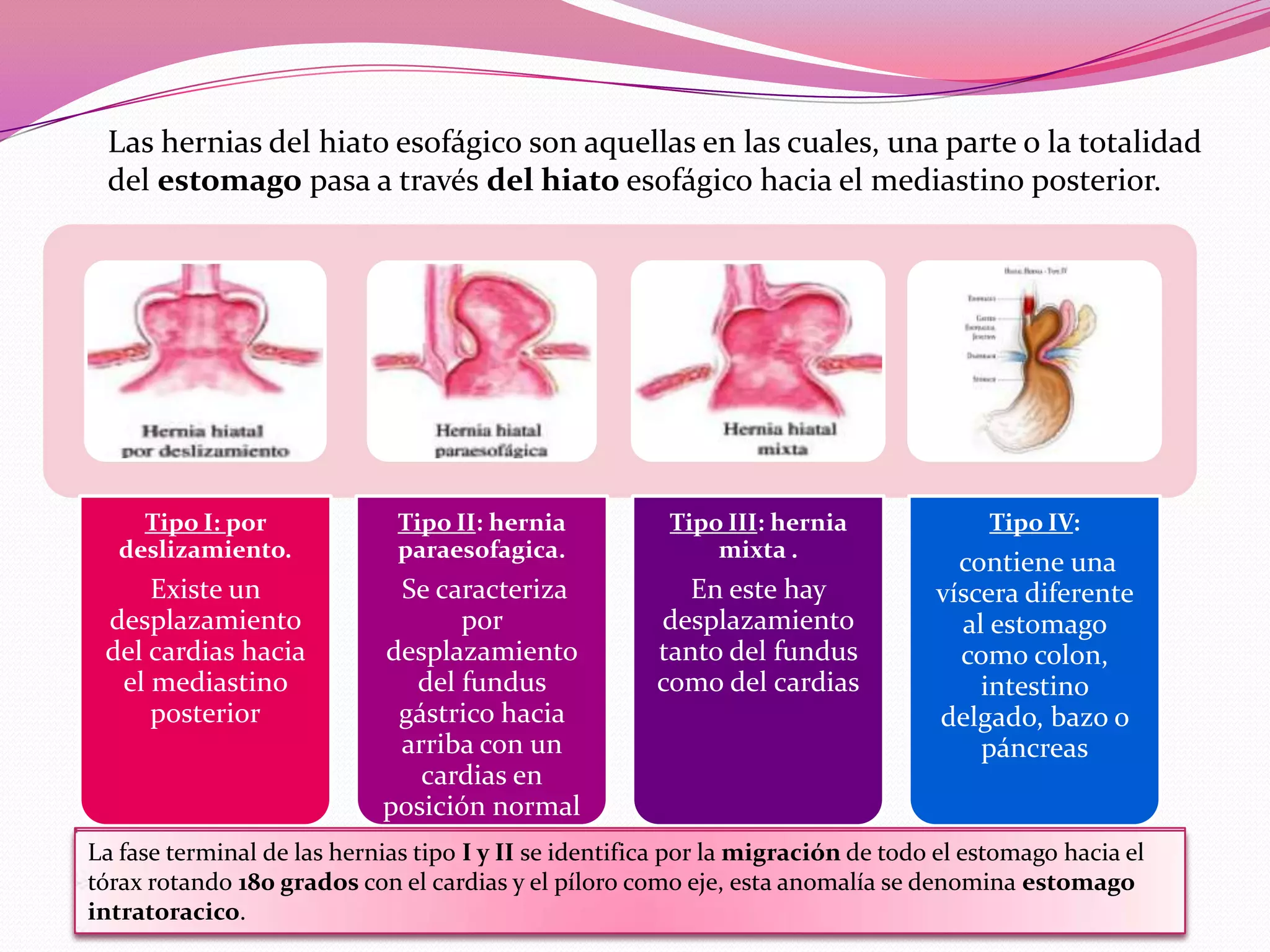 Esófago, hernia hiatal, y acalasia | PPTX