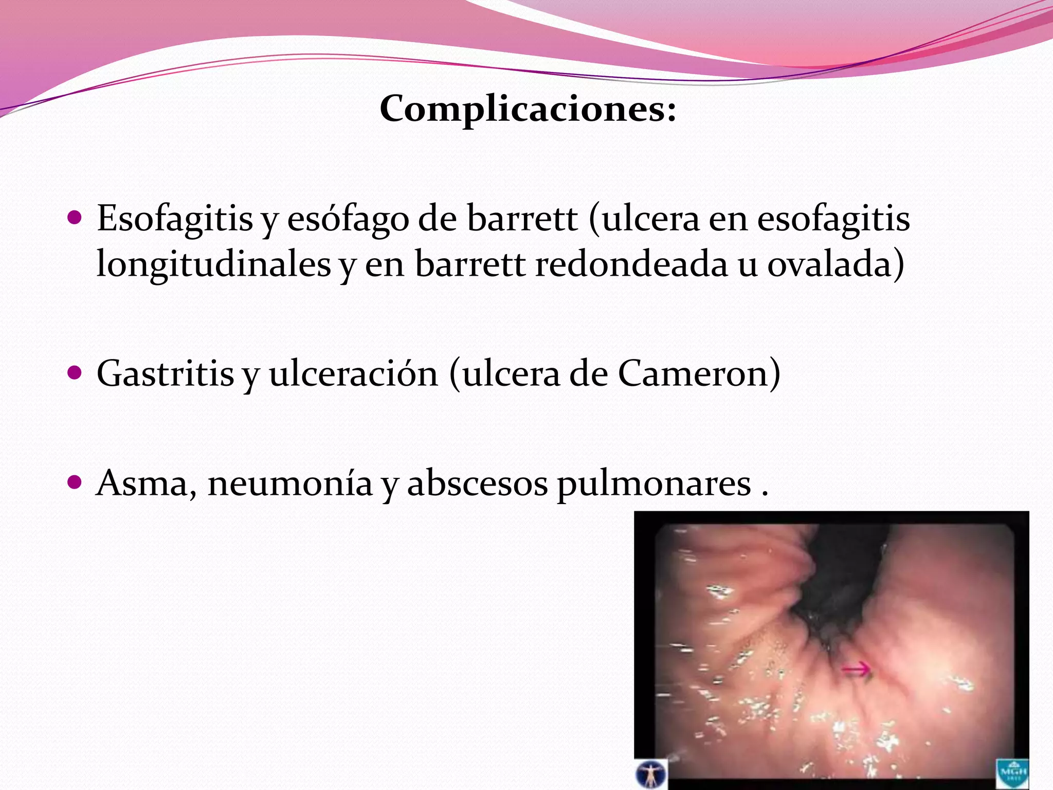 Esófago, hernia hiatal, y acalasia | PPTX