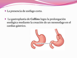 Esófago, hernia hiatal, y acalasia | PPTX