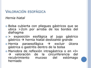 Esófago y hernia diafragmática | PPTX
