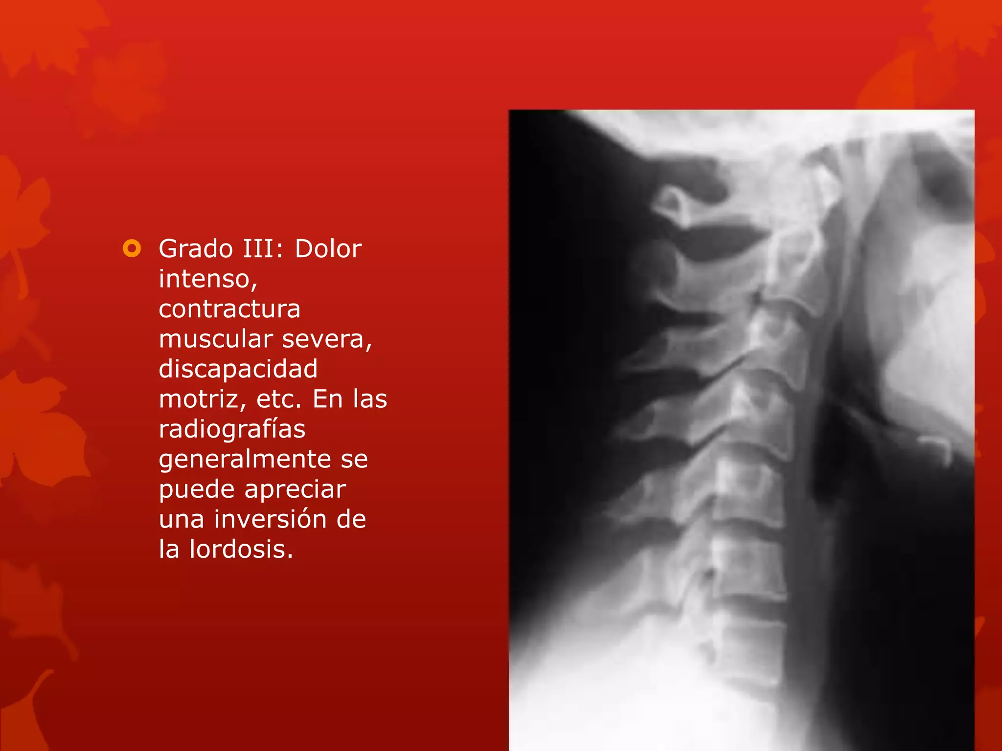 Esguince cervical | PPTX