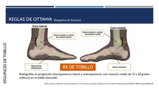 ESGUINCES DE TOBILLO TRAUMATOLOGIA Y ORTOPEDIA | PPTX