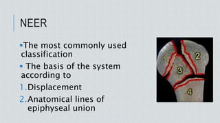 anapath of proximal humerus fractures.pptx