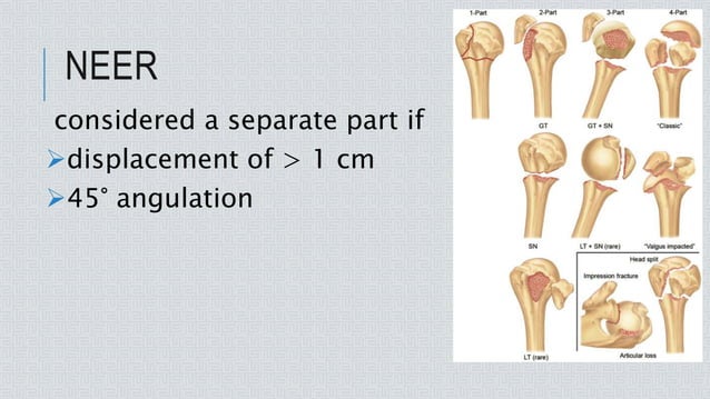 anapath of proximal humerus fractures.pptx