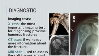 anapath of proximal humerus fractures.pptx