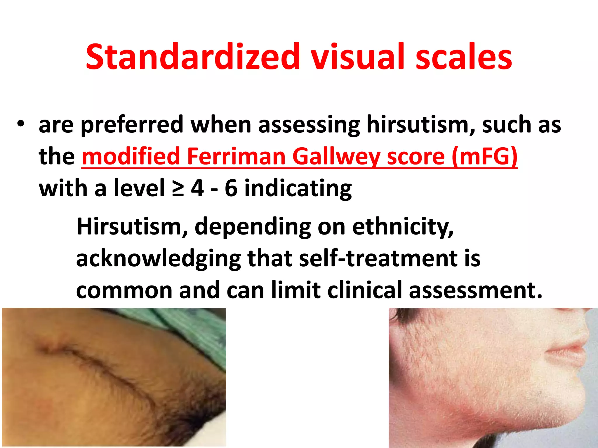 Recent 2018 ESHRE & ASRM evidence based guidelines for PCOS assement ...