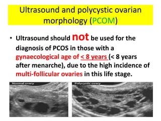 Recent 2018 ESHRE & ASRM evidence based guidelines for PCOS assement | PDF