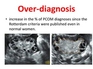 Recent 2018 ESHRE & ASRM evidence based guidelines for PCOS assement | PDF