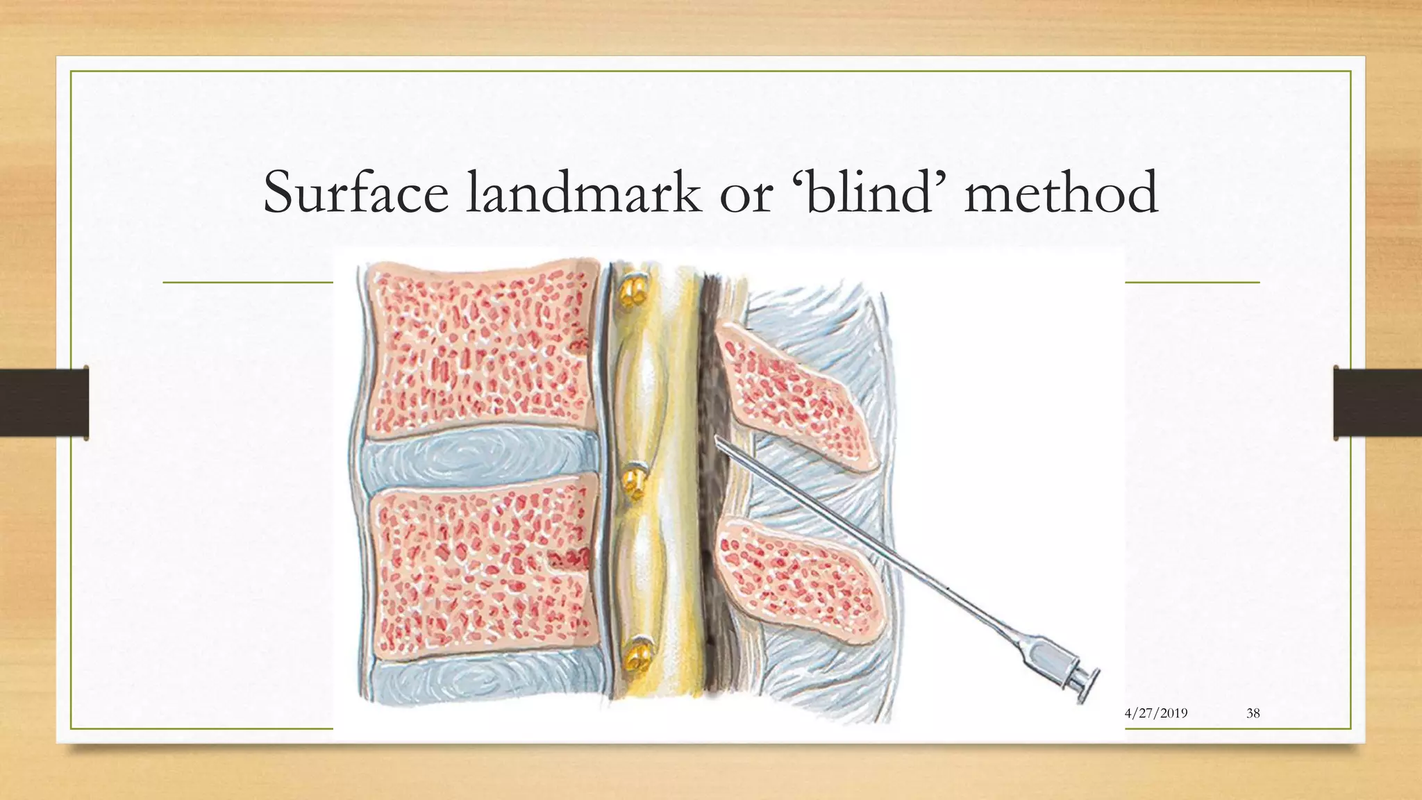 Epidural Steroid Injection in low back pain | PPTX