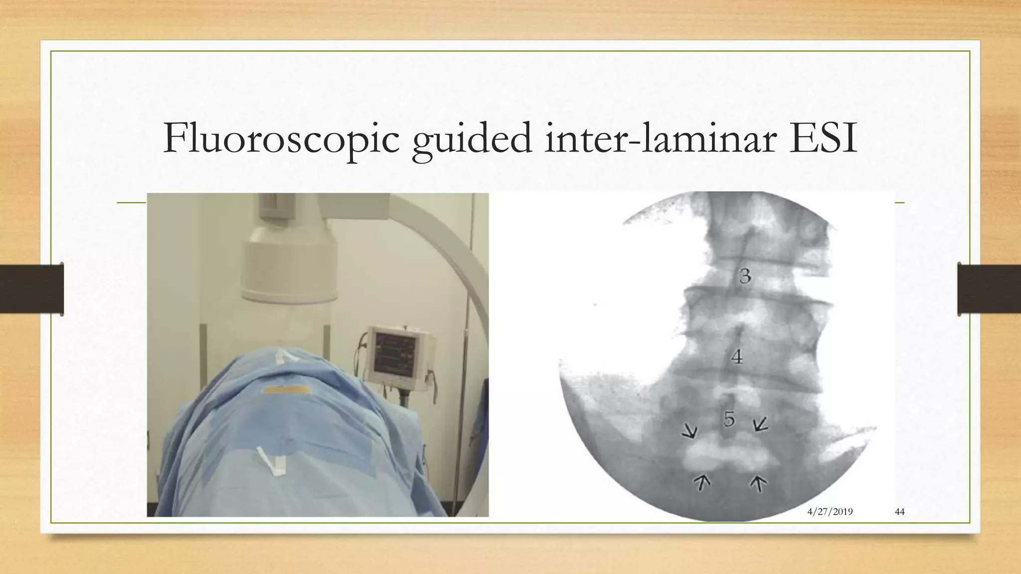 Epidural Steroid Injection in low back pain | PPTX