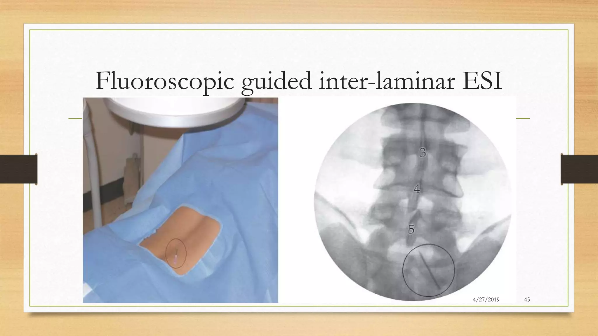Epidural Steroid Injection in low back pain | PPTX