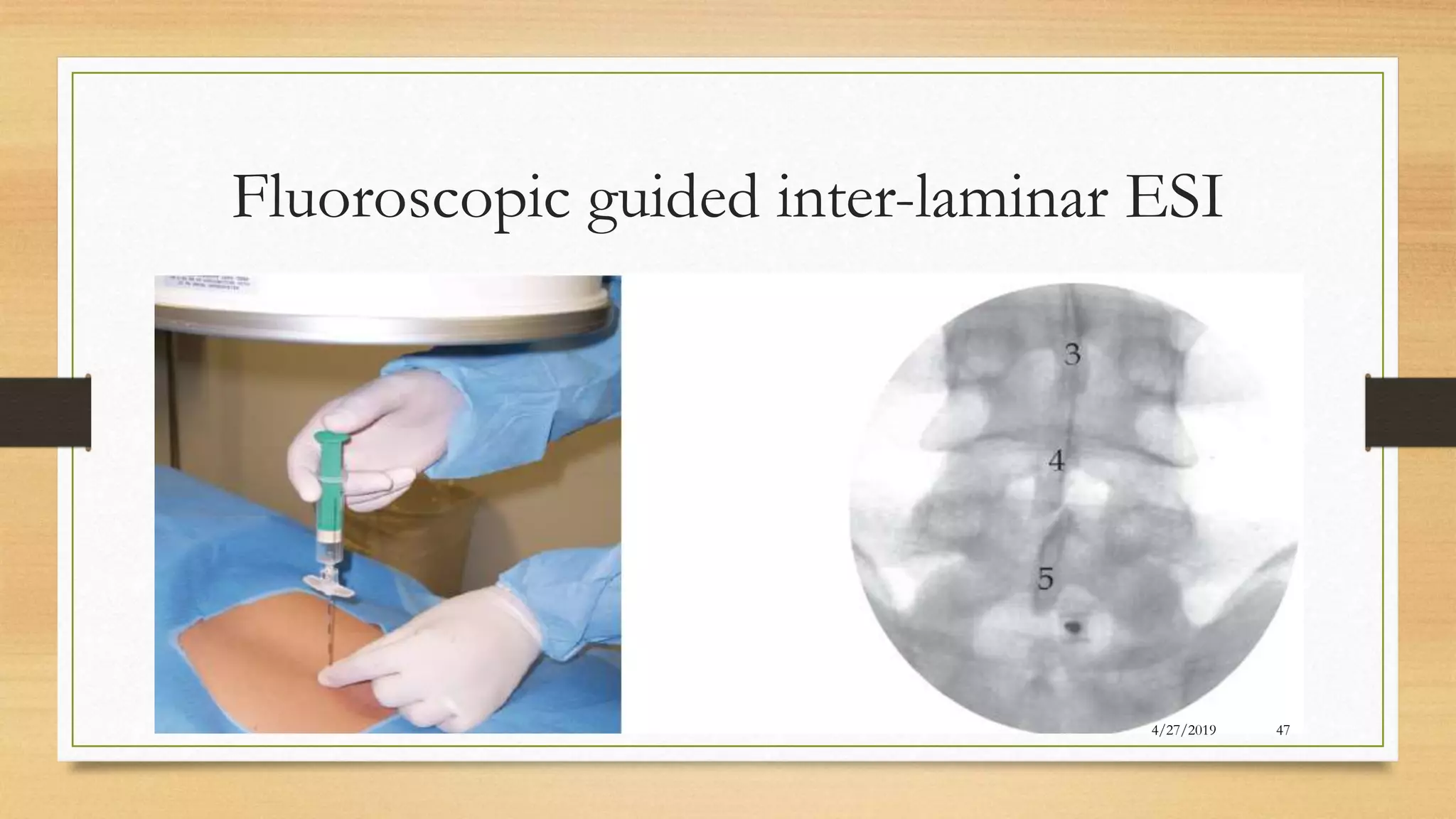 Epidural Steroid Injection in low back pain | PPTX
