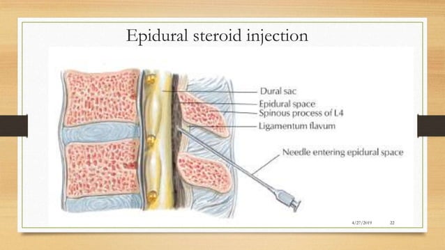 Epidural Steroid Injection in low back pain | PPTX