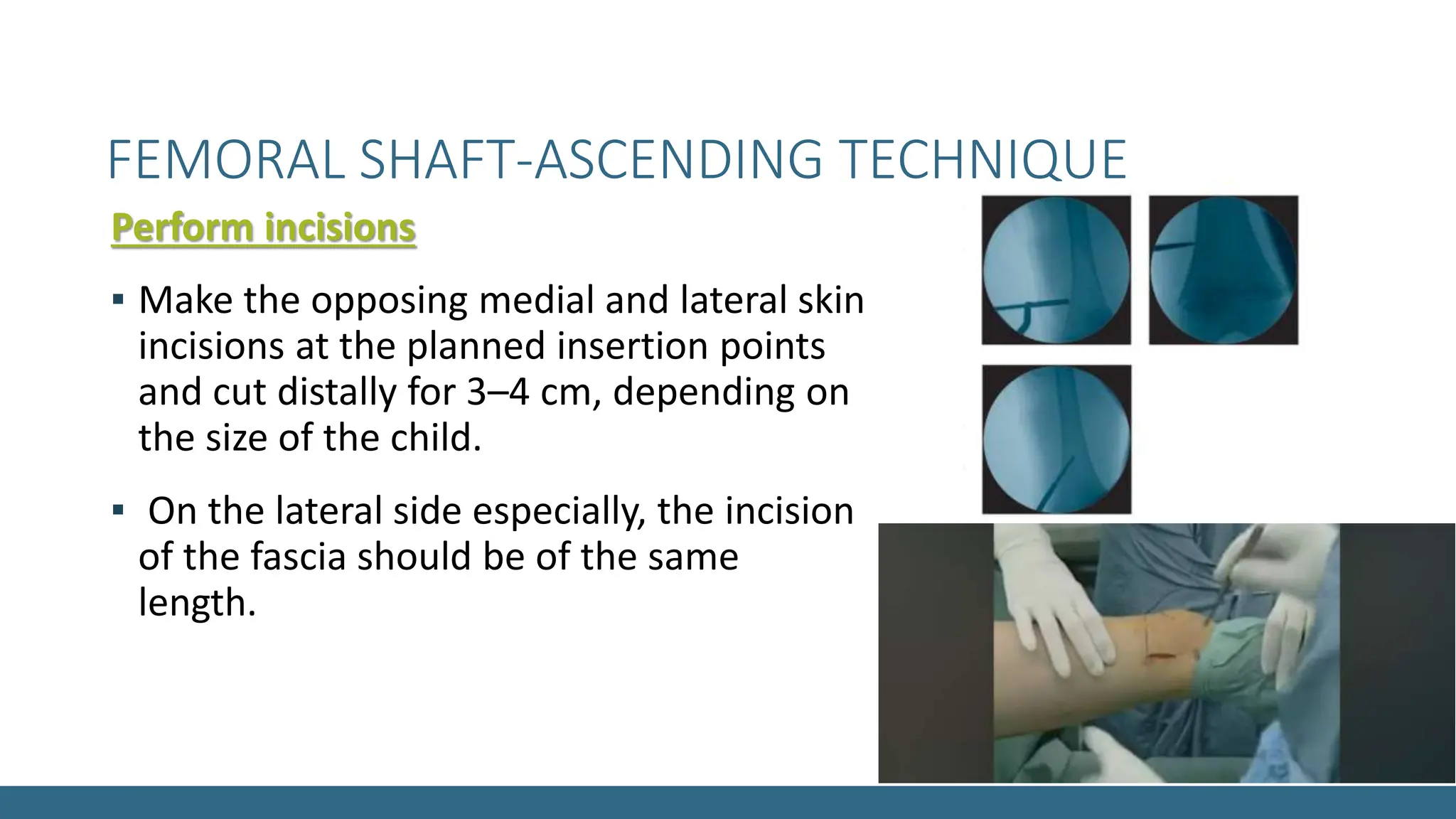 ESIN LOWER LIMB FEMUR AND TIBIA FRACTURES .pptx