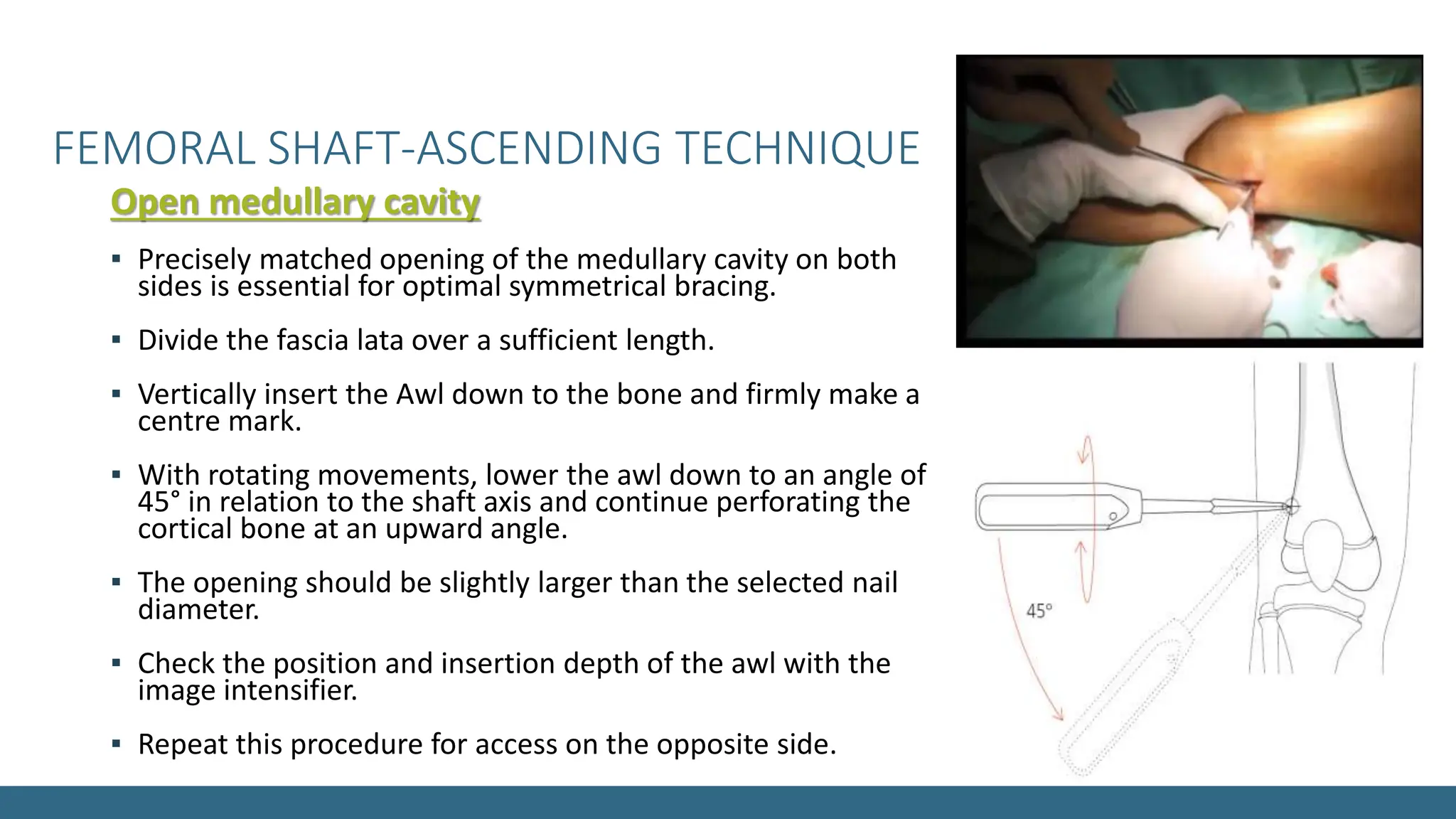 ESIN LOWER LIMB FEMUR AND TIBIA FRACTURES .pptx