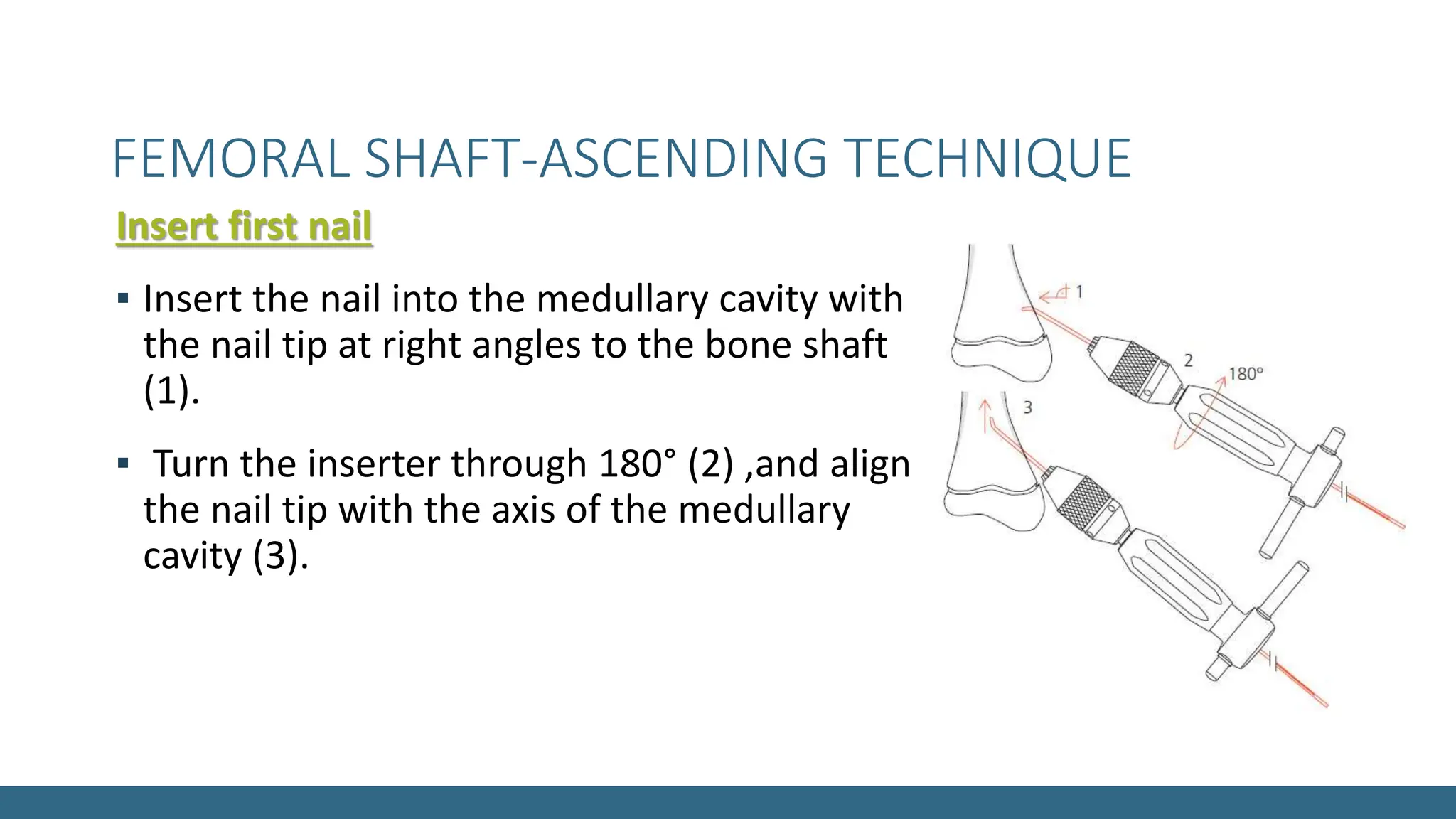 ESIN LOWER LIMB FEMUR AND TIBIA FRACTURES .pptx