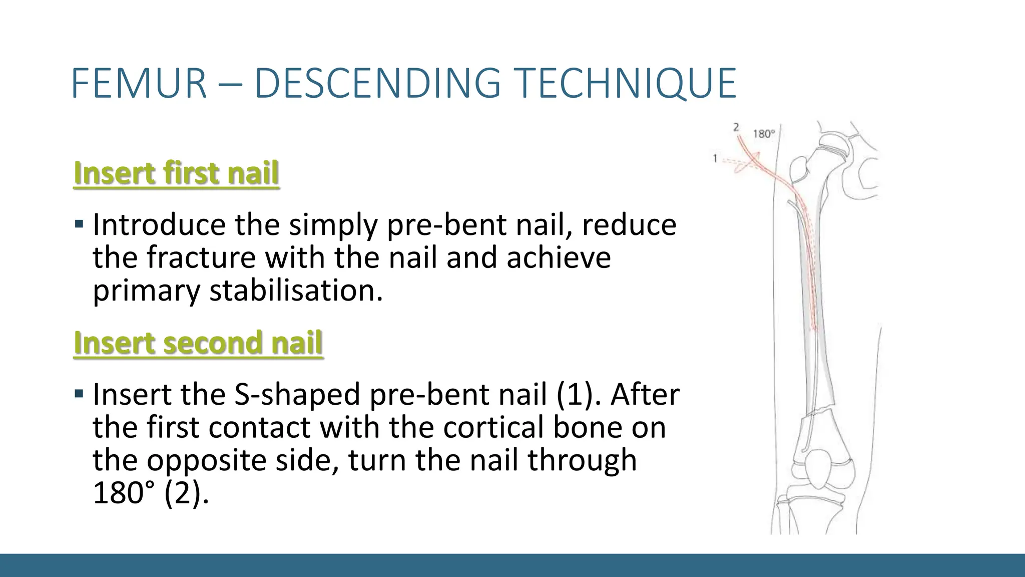 ESIN LOWER LIMB FEMUR AND TIBIA FRACTURES .pptx