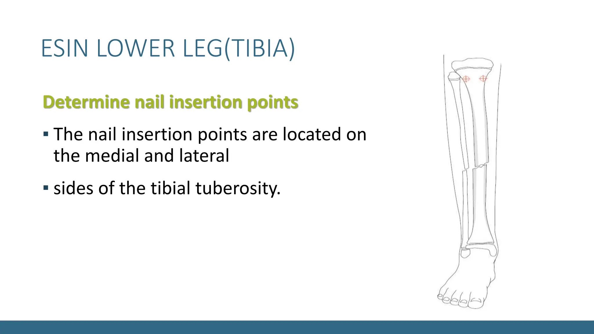 ESIN LOWER LIMB FEMUR AND TIBIA FRACTURES .pptx