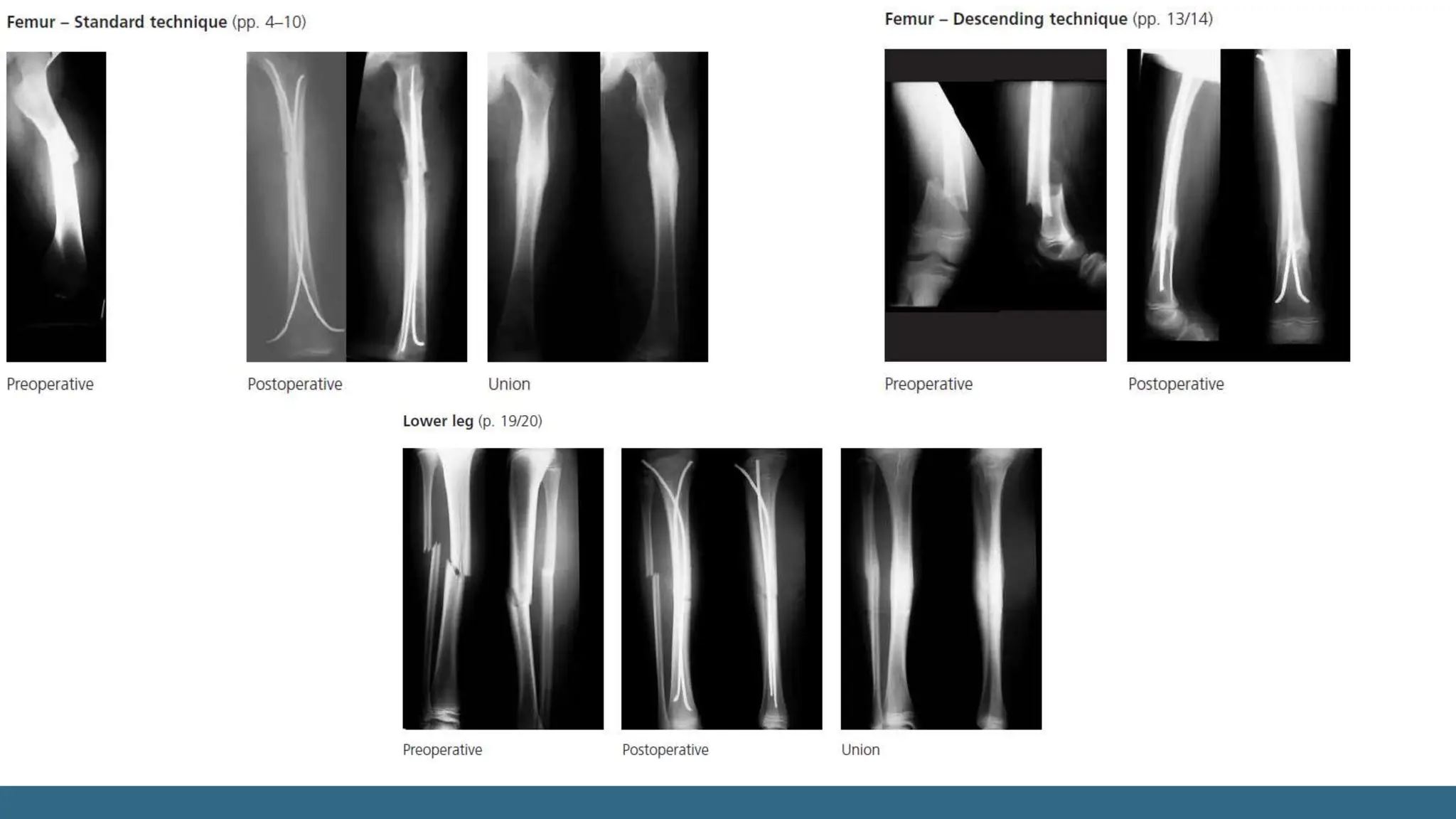 ESIN LOWER LIMB FEMUR AND TIBIA FRACTURES .pptx