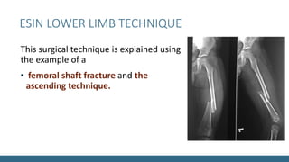 ESIN LOWER LIMB FEMUR AND TIBIA FRACTURES .pptx