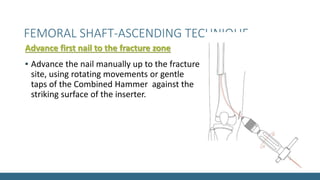 ESIN LOWER LIMB FEMUR AND TIBIA FRACTURES .pptx