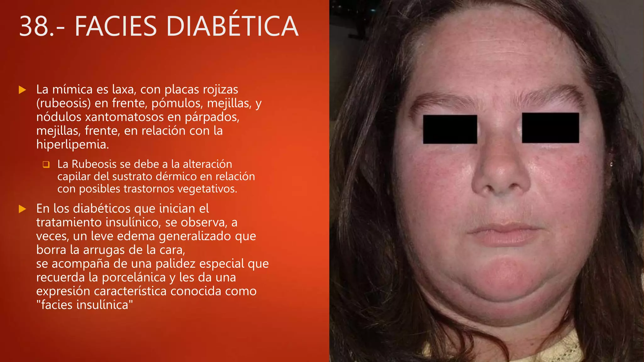 TIPOS DE FACIES | PPTX | Eye and Vision Conditions | Diseases and ...