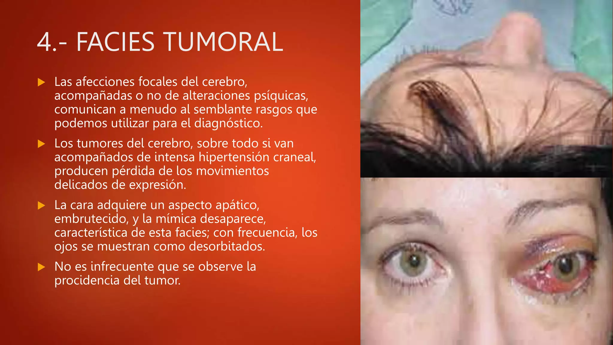 TIPOS DE FACIES | PPTX | Eye and Vision Conditions | Diseases and ...