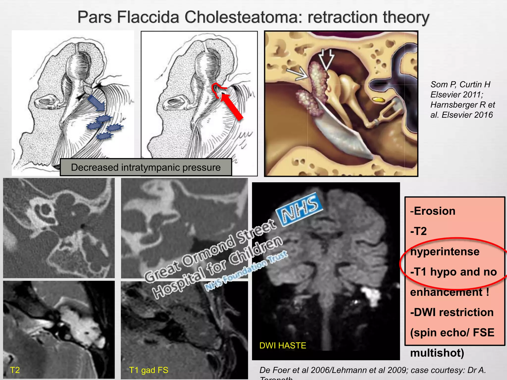 inflammations of the Temporal Bone: Imaging and differential diagnosis ...