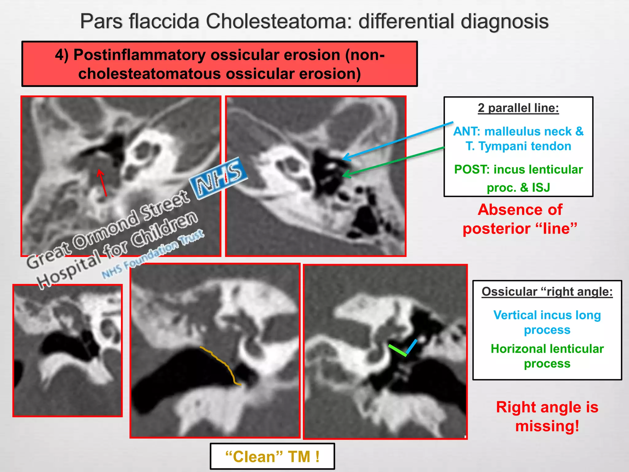 inflammations of the Temporal Bone: Imaging and differential diagnosis ...