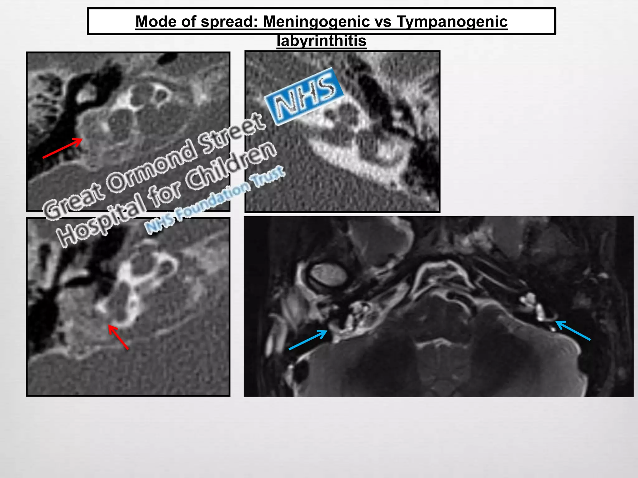 inflammations of the Temporal Bone: Imaging and differential diagnosis ...