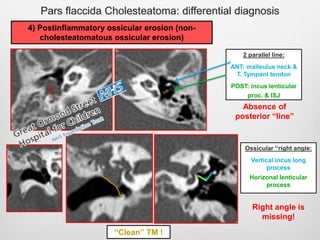 inflammations of the Temporal Bone: Imaging and differential diagnosis ...