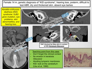 inflammations of the Temporal Bone: Imaging and differential diagnosis ...