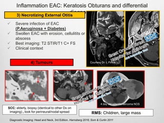 inflammations of the Temporal Bone: Imaging and differential diagnosis ...