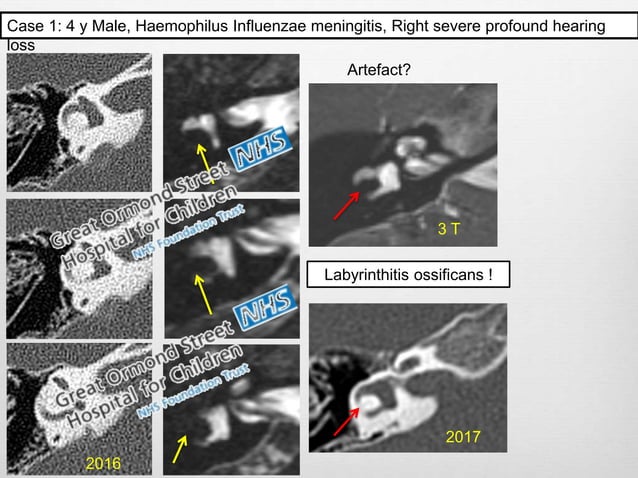 inflammations of the Temporal Bone: Imaging and differential diagnosis ...