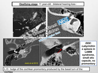 inflammations of the Temporal Bone: Imaging and differential diagnosis ...