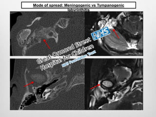 inflammations of the Temporal Bone: Imaging and differential diagnosis ...