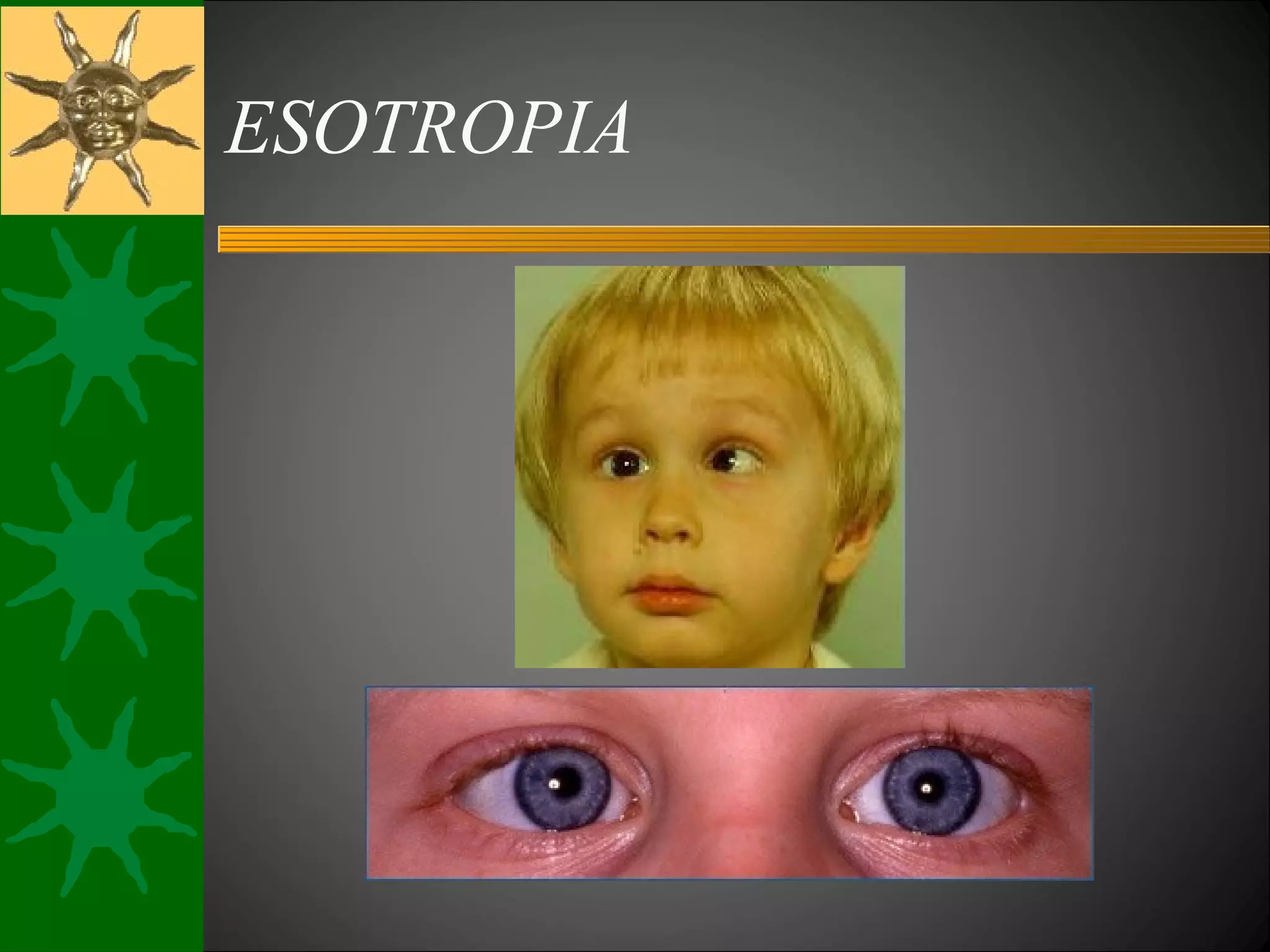 Eso deviation | PPT