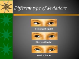 Eso deviation | PPT