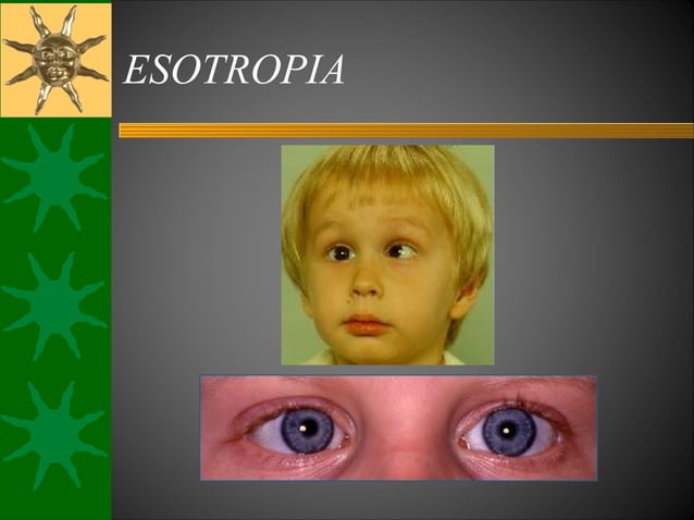 Eso deviation | PPT | Eye and Vision Conditions | Diseases and Conditions