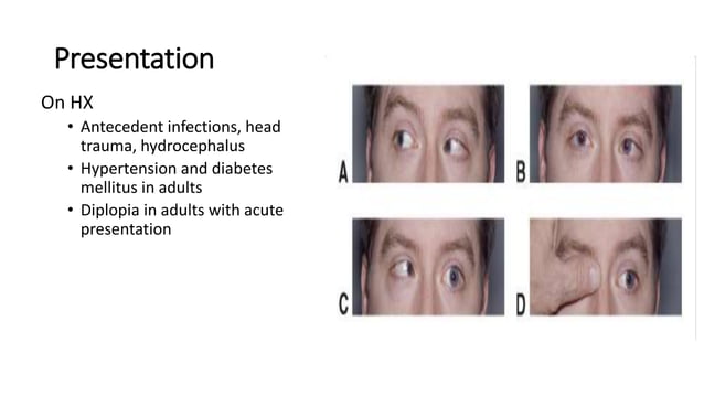 Esodeviation(1) | PPTX