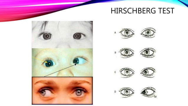 ESODEVIATION AND ITS APPROACH.pptx | Eye and Vision Conditions | Diseases and Conditions